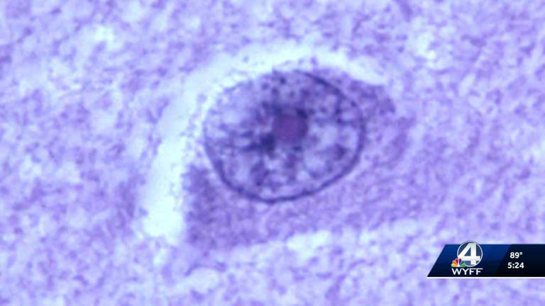 Pediatric patient dies from brain-eating amoeba, officials say