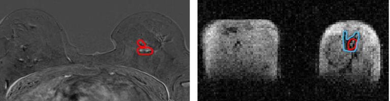 World’s first ultra-low magnetic scanner will change breast cancer ...