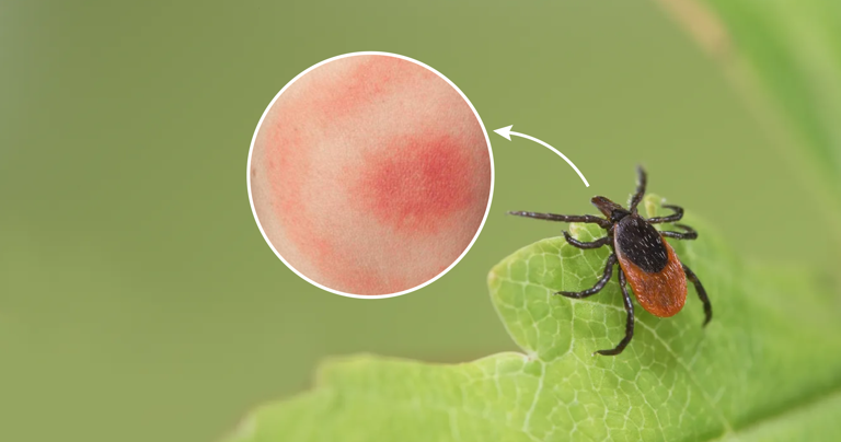 Tick season active this year, including in Alabama. Do you know the ...