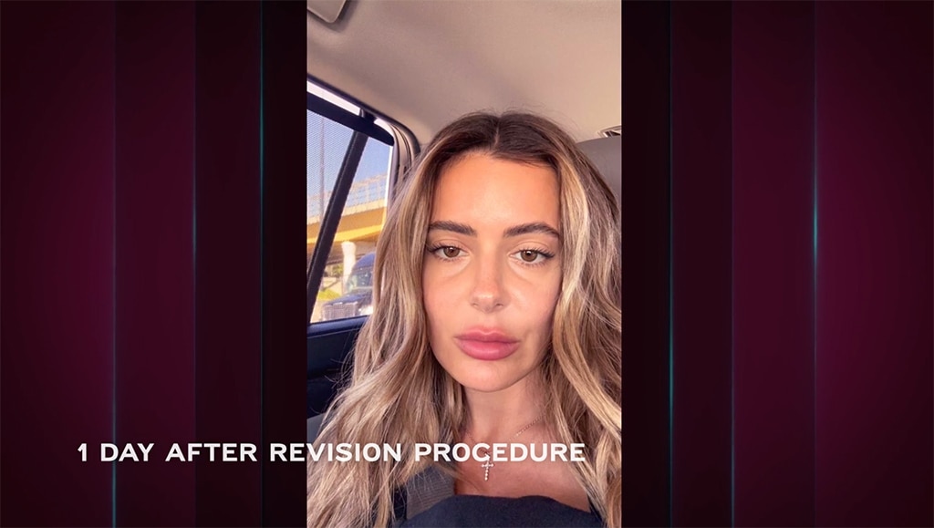 Brielle Biermann Shares Warning After Dissolving Her Under-Eye Filler