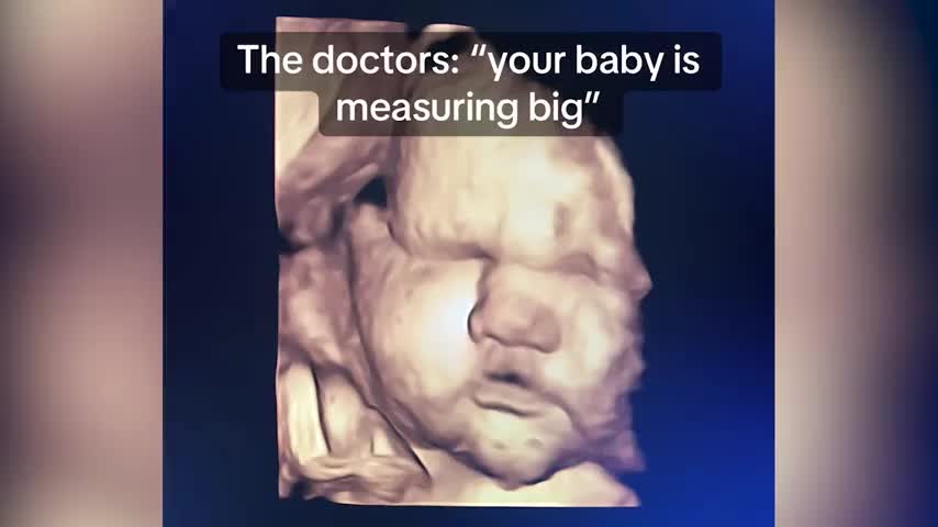 3D Scan Says Baby’s Big—Then He’s Born