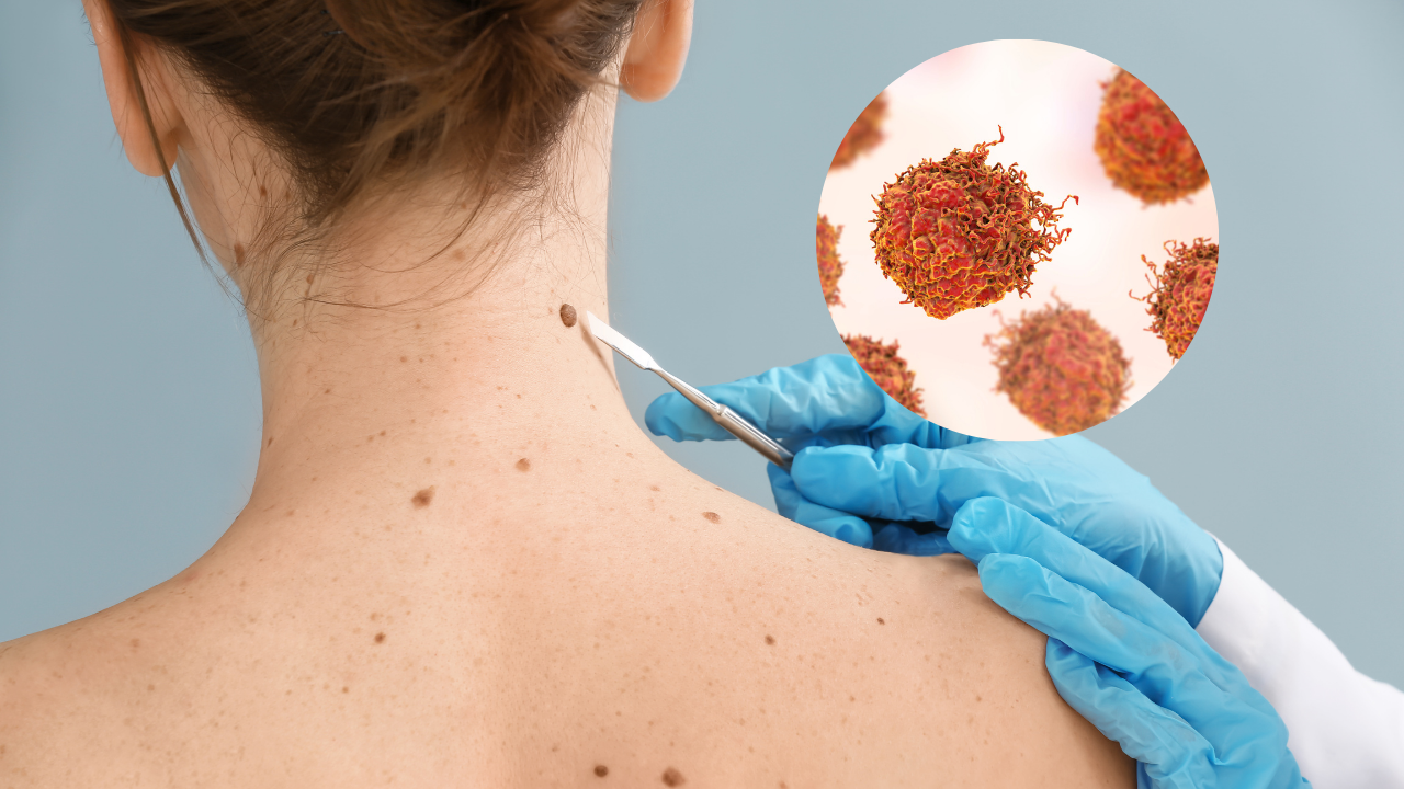 A Strain Of Typically Harmless HPV Caused 40 Skin Cancer Lesions In A ...