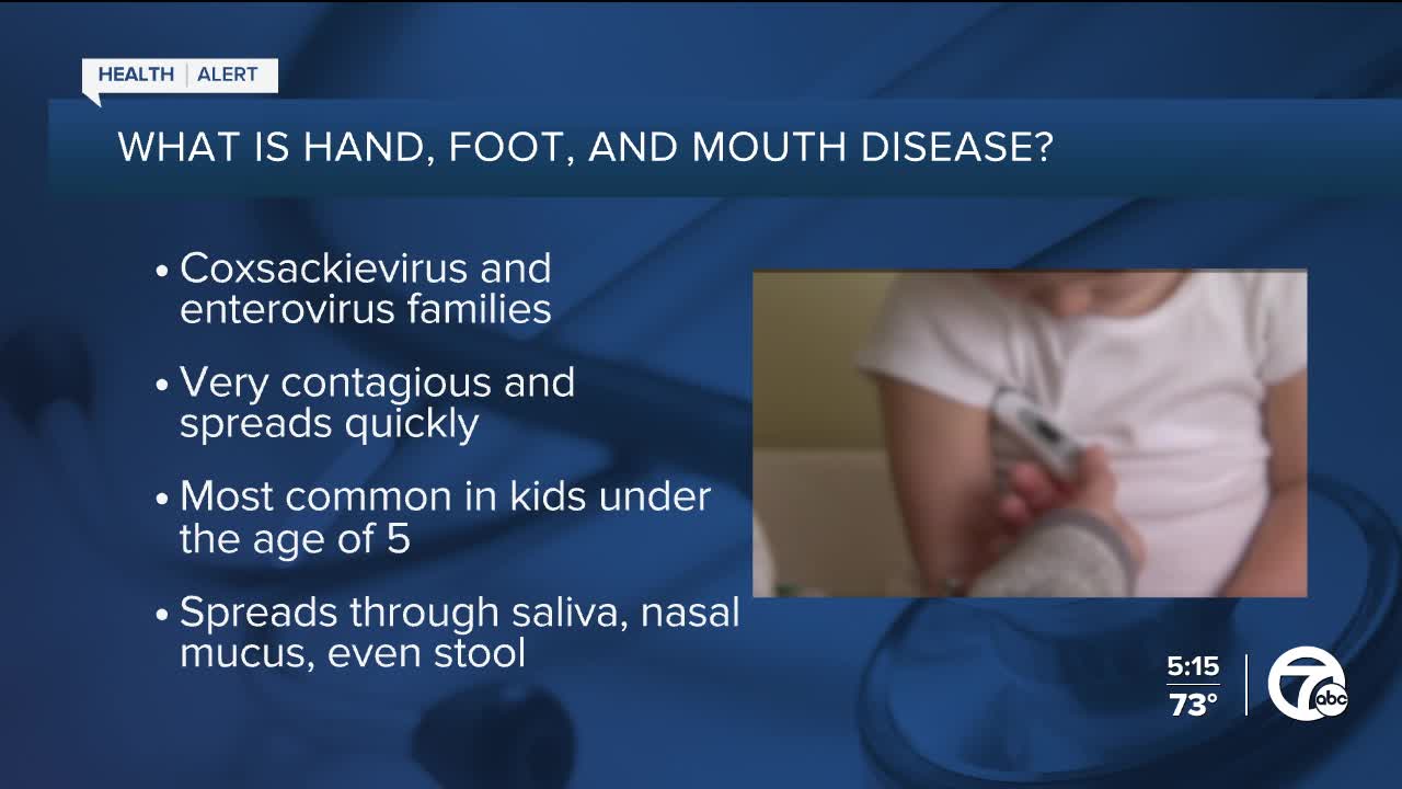 Doctors issue warning about hand, foot, and mouth disease. Here's what ...
