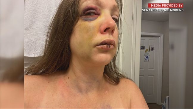 Cincinnati fight video sparks political debate, GOP senator shares victim's injury photos
