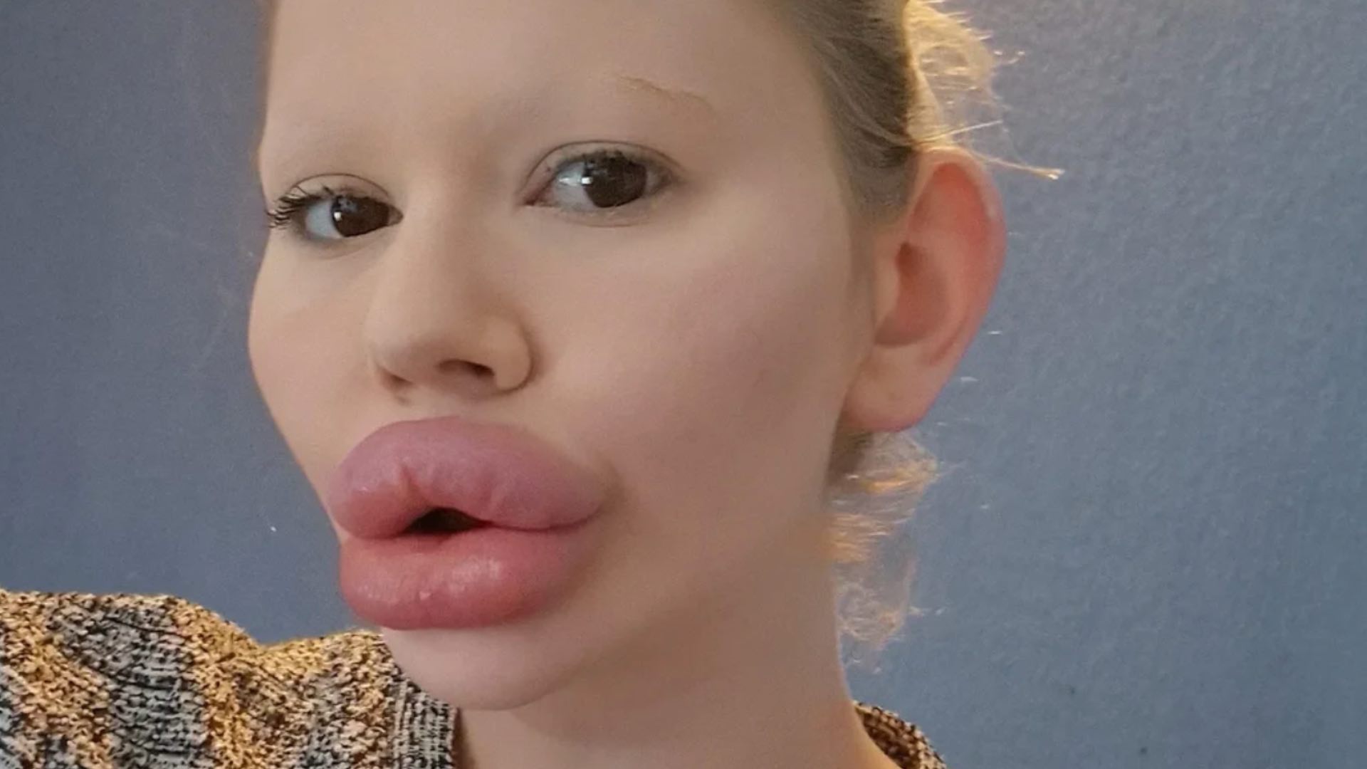 The woman with the biggest lips in the world is intriguing: her face ...