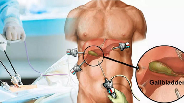 Gallbladder removal: What happens after surgery, side effects and foods to avoid