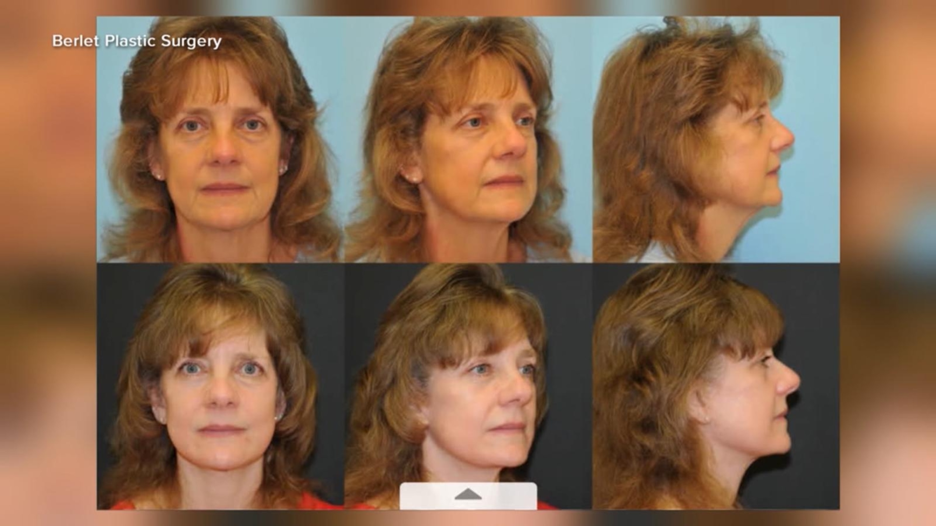Woman undergoes face lift to overcome ‘Ozempic face’