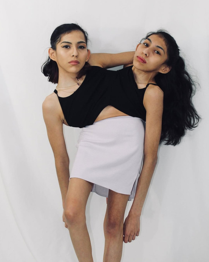 One Conjoined Twin Got Married — And Everyone’s Asking the Same Question