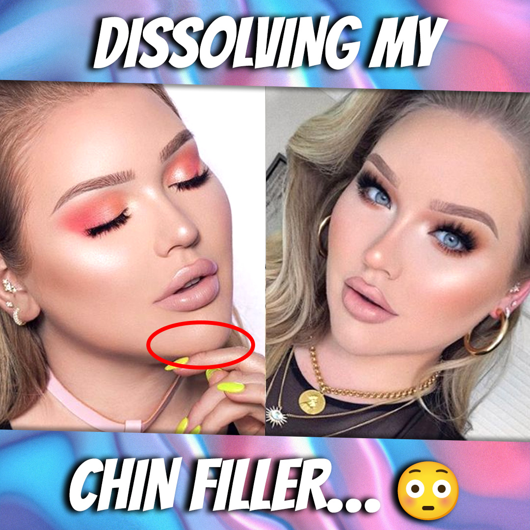 Dissolving My Chin Filler