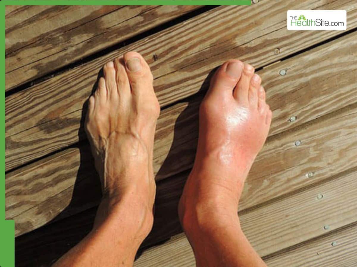 5 Health Conditions High Uric Acid Can Cause