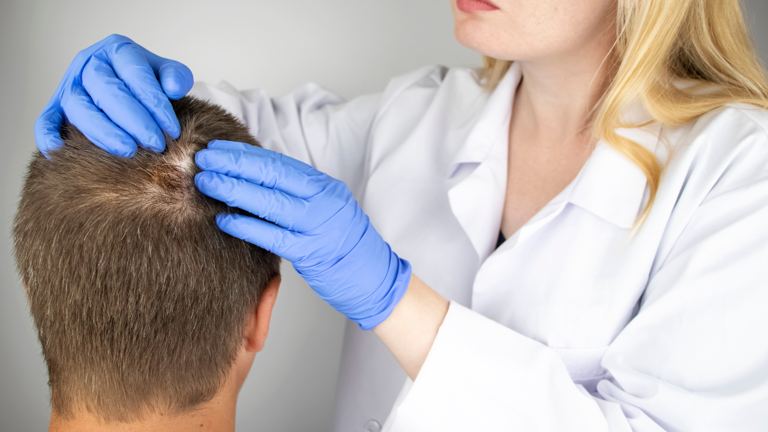 World Alopecia Day 2025: Theme, Origin, And Significance