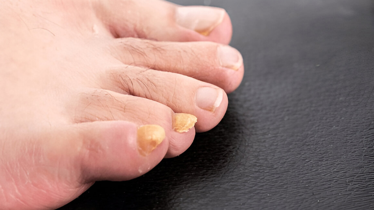 Rainy Season Nail Problems: Why Toenails Turn Yellow Or Soft And What To Do