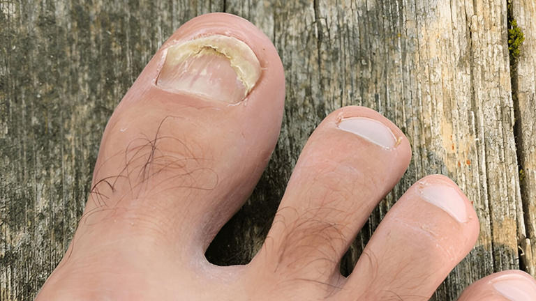Rainy Season Nail Problems: Why Toenails Turn Yellow Or Soft And What To Do