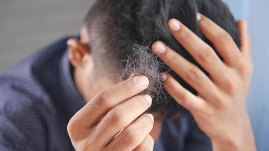 Is stress the only cause of alopecia? Dermatologist debunks 4 common ...