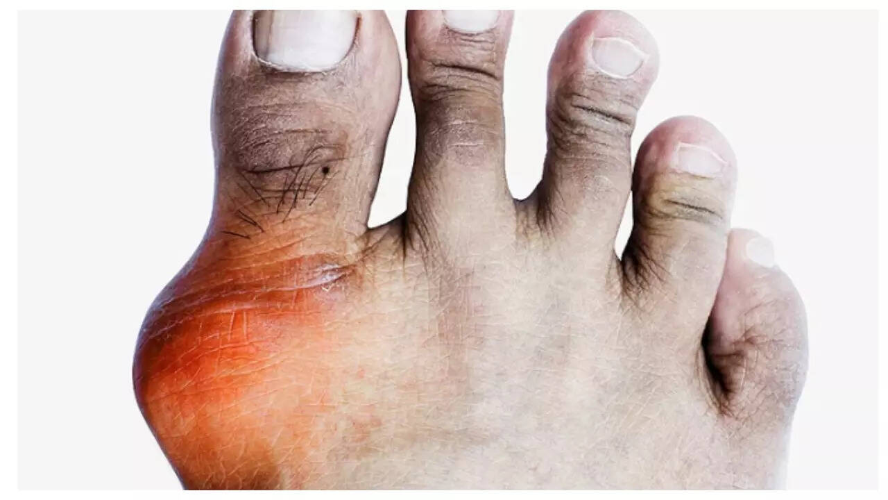 5 simple daily habits to keep uric acid levels in check