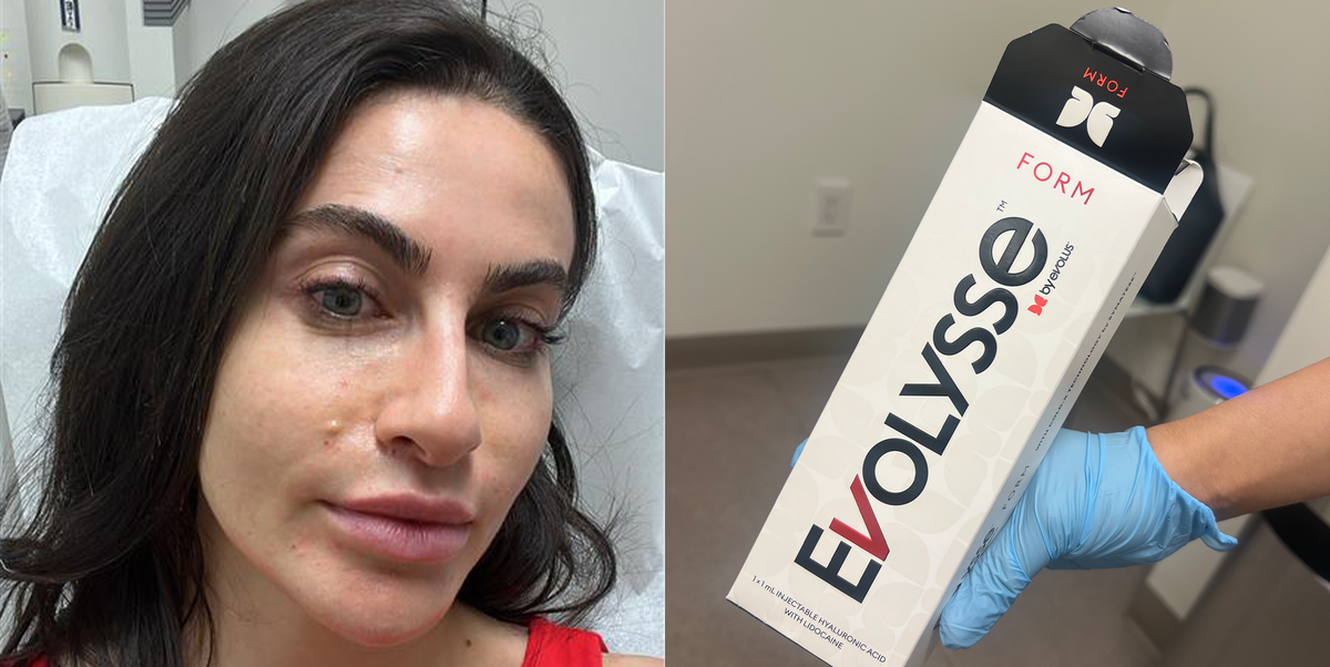 Cosmo Exclusive: Can Injectables Ever Look Natural? I Tried The Newest ...