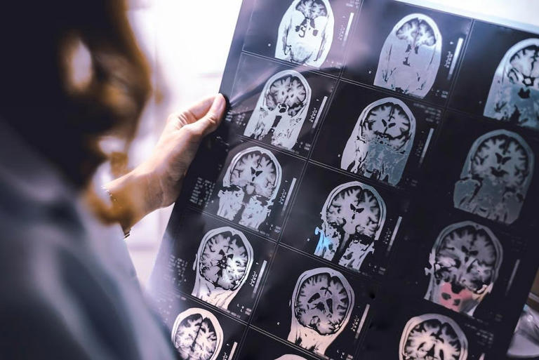 Multiple sclerosis could affect health years before classic symptoms