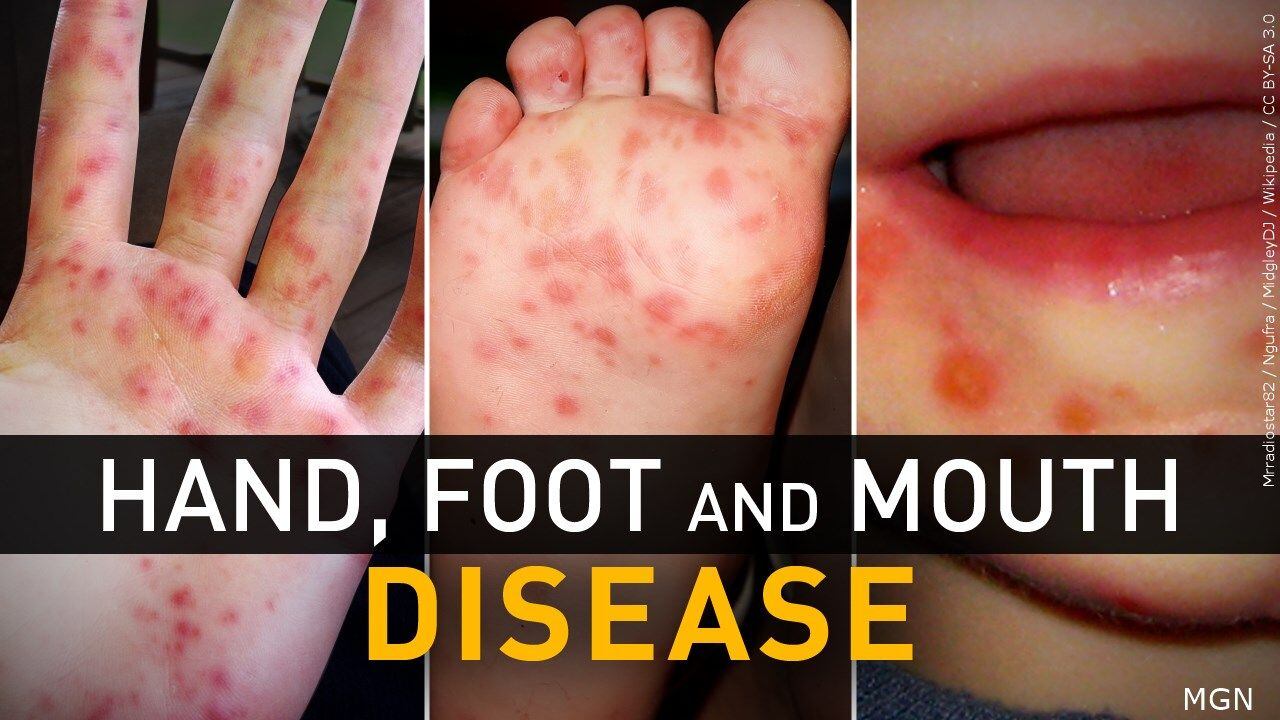 UP doctors see increase in cases of hand, foot and mouth disease