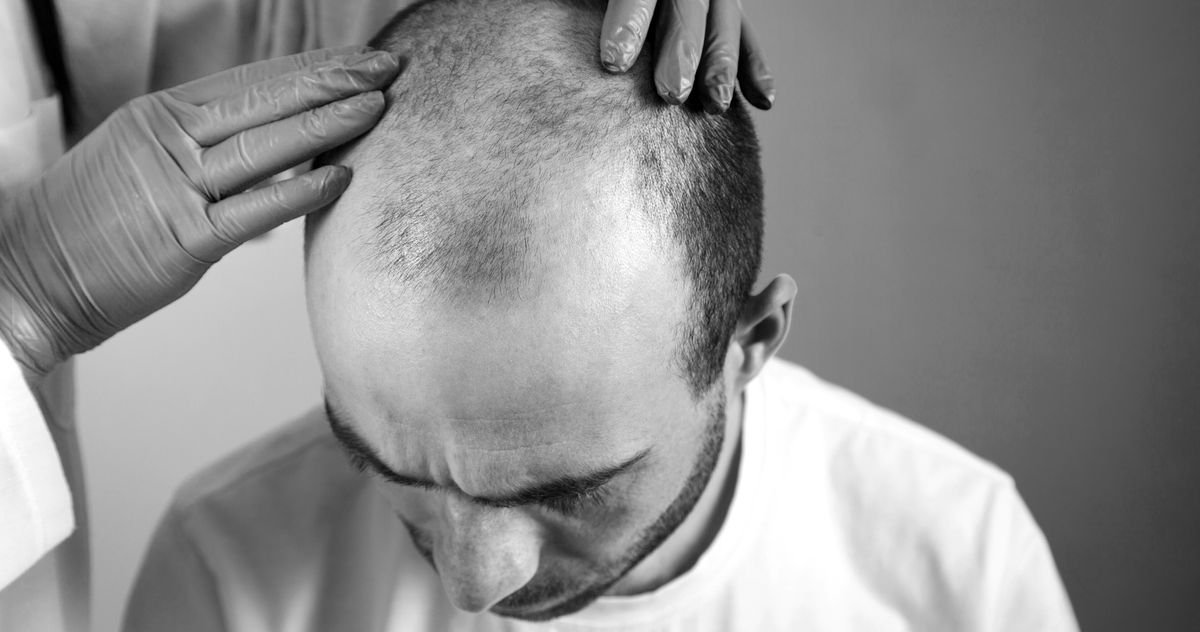 British Man Dies While Preparing for Turkish Hair Transplant