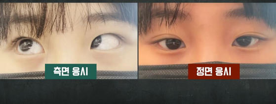 Cosmetic eye surgery results in double vision, eye misalignment, woman ...