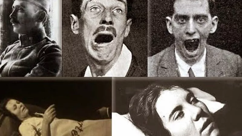 Doctors Baffled by Catatonic Illness That Turns Patients into ‘Zombies’