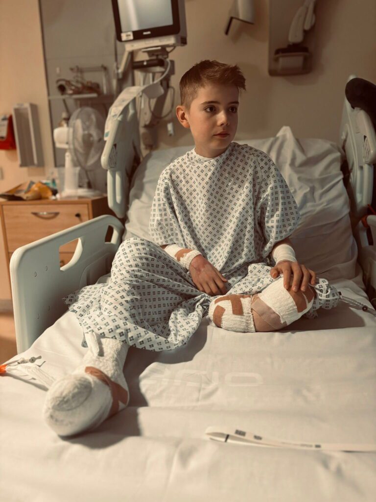 Boy, 13, loses both legs after “camp leg cramp” turns out to be sepsis