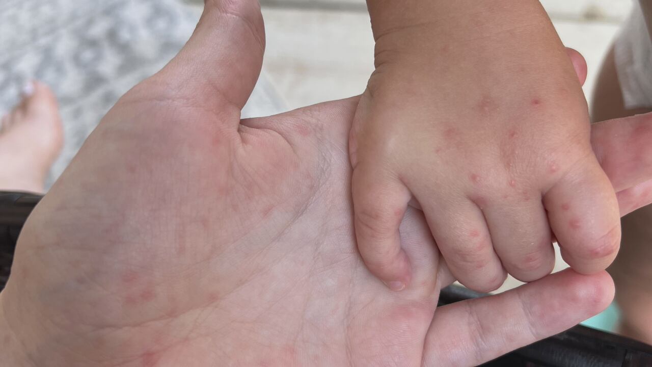 Lubbock Public Health reports spread of Hand, Foot, and Mouth Disease ...