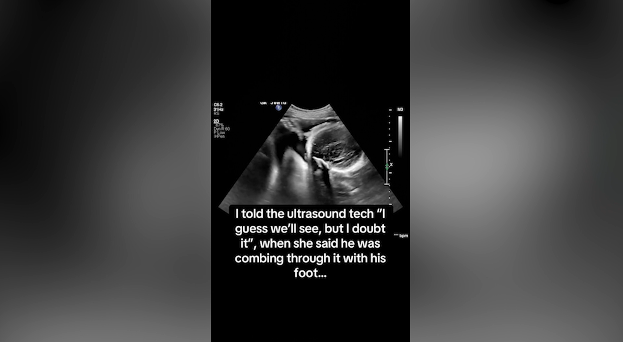 Baby Seen ‘Combing’ Hair On Ultrasound—Shock At What It Looks Like Now