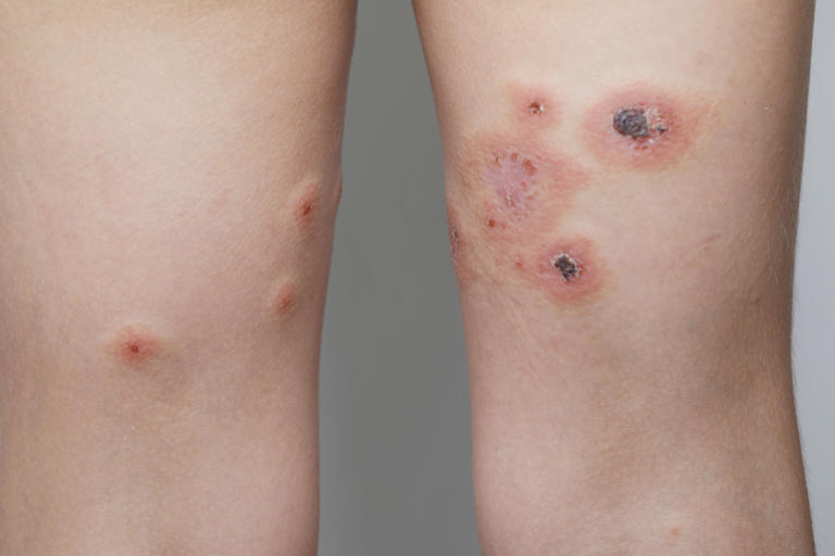 How to identify your child's rash and when to know if it's serious
