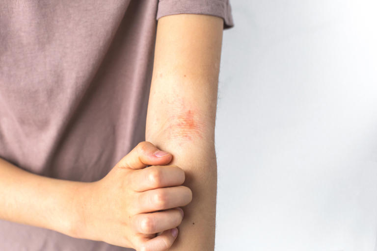 How to identify your child's rash and when to know if it's serious
