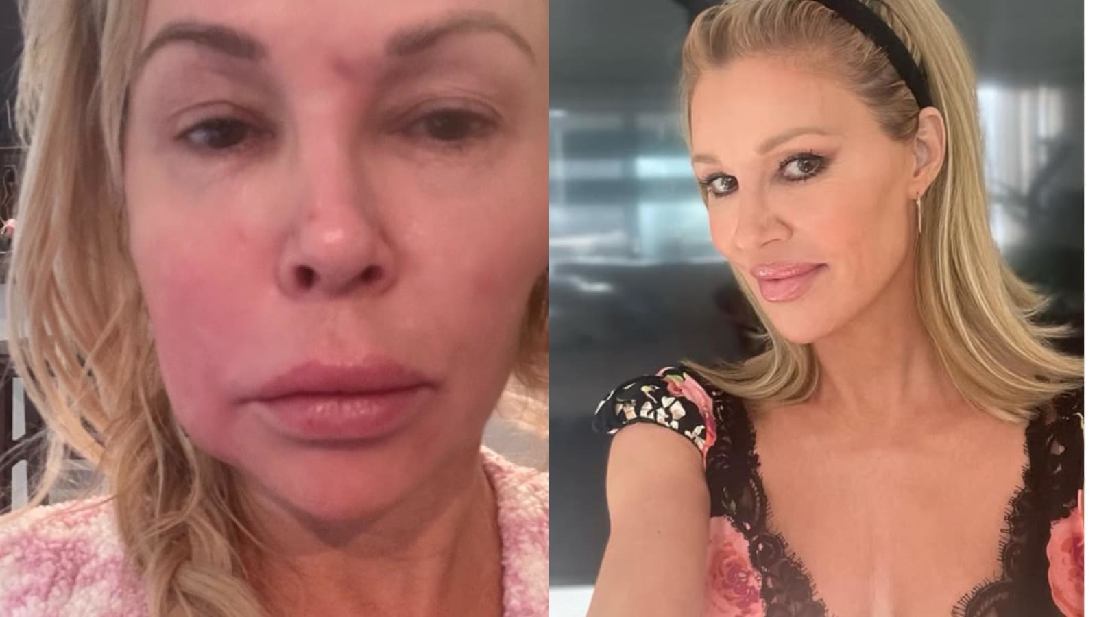 Real Housewives Star Brandi Glanville Suffers Painful Chemical Burns ...