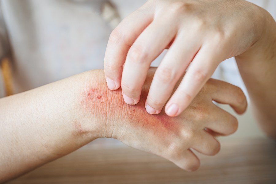 California outbreak of flea-borne typhus infections investigated