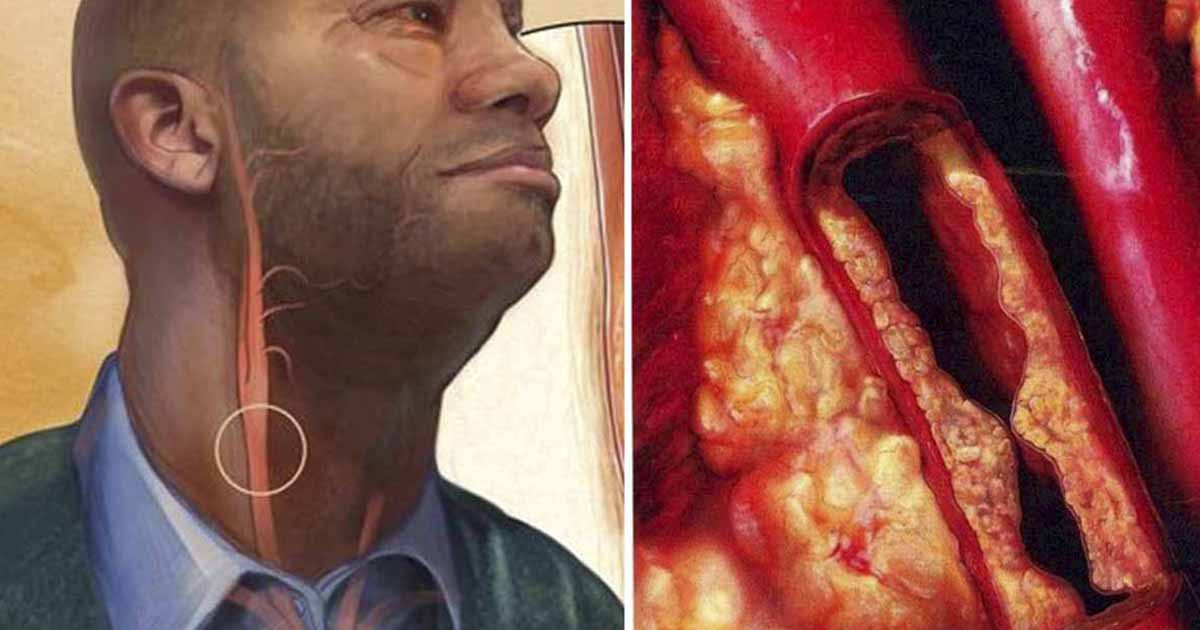 How to Recognize and Fight Clogged Arteries: Signs, Prevention, and ...
