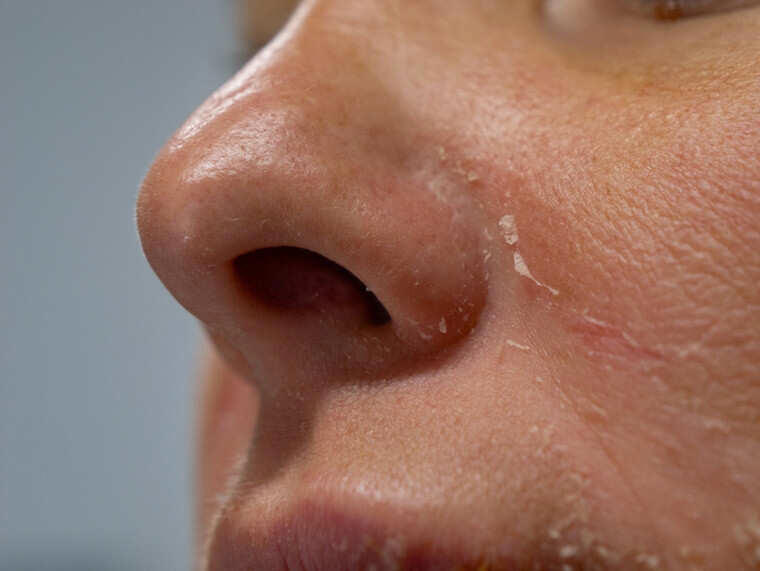 10 Early Signs Of Vitamin A Deficiency You Should Not Ignore