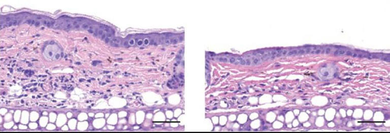 Breakthrough offers hope for treating eczema and skin conditions