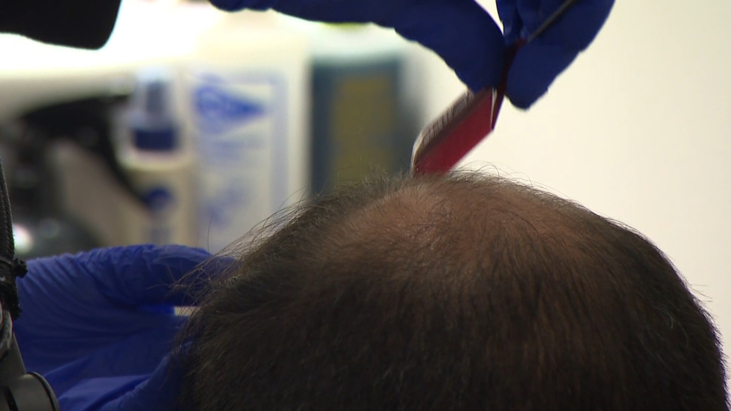 New trial hopes to make baldness 'perfectly optional'