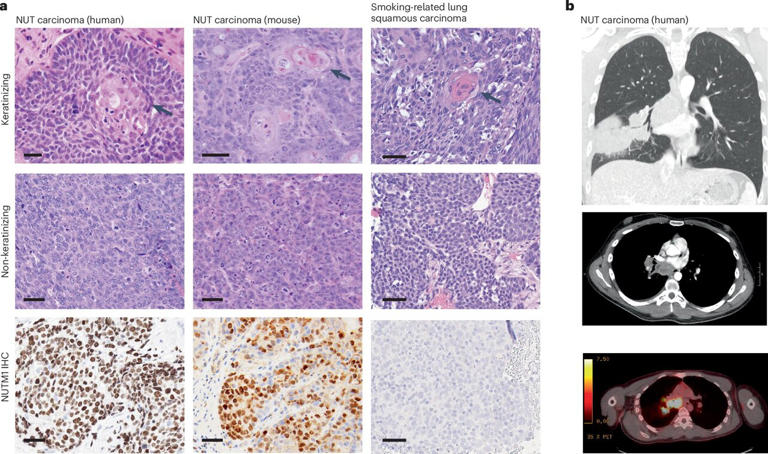 Study paves path to improved diagnosis, treatment of NUT carcinoma