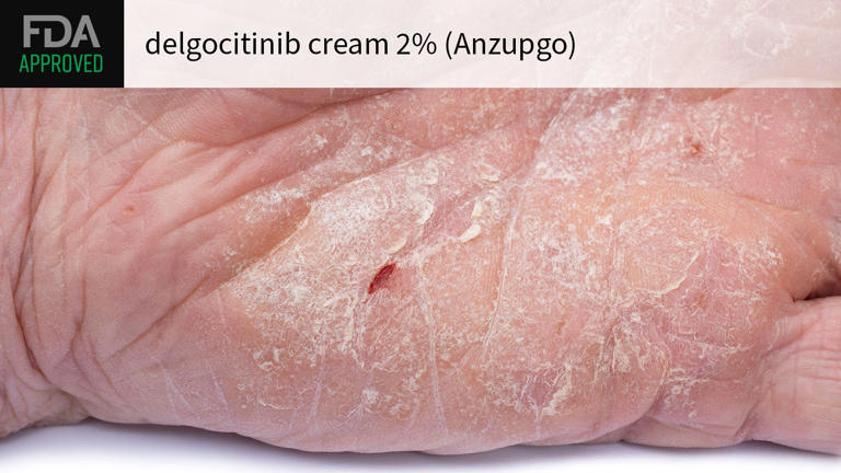 First Topical Therapy for Chronic Hand Eczema Wins FDA Approval