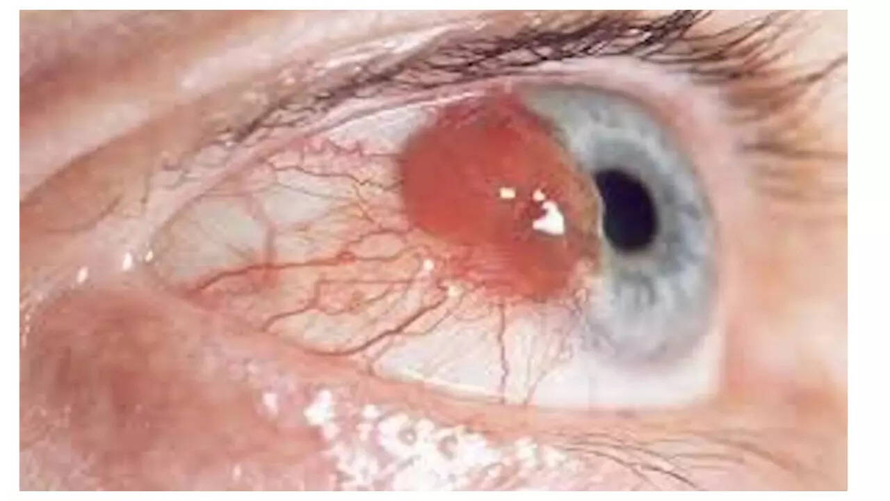 Eye cancer: 7 early signs and symptoms one should not ignore