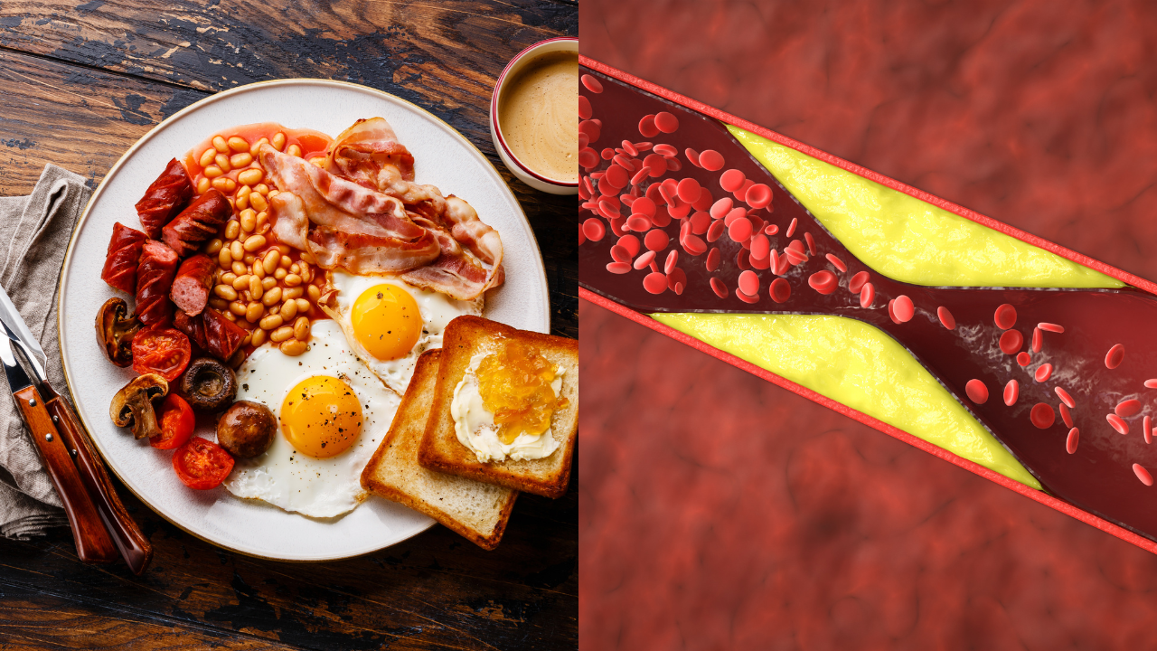 Two Breakfast Foods People With High Cholesterol Should Absolutely Avoid