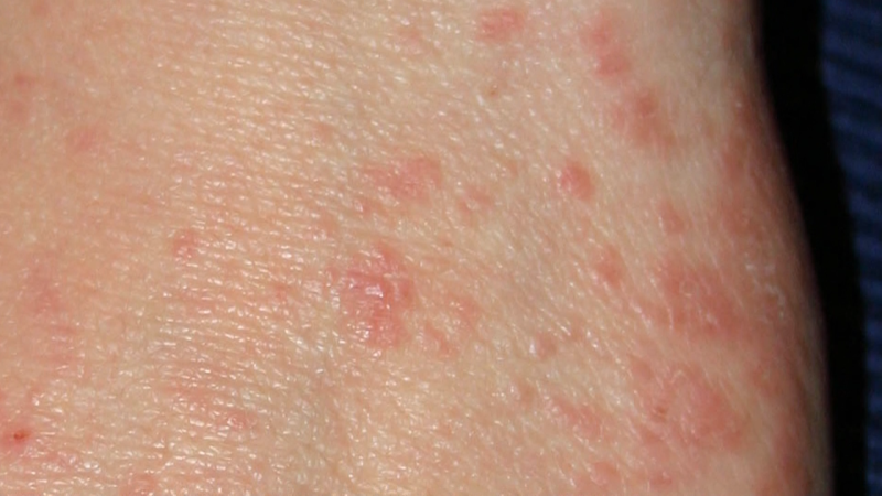 Svrab se šíří Českem: Onemocnělo už přes pět tisíc lidí. Hygienici ...