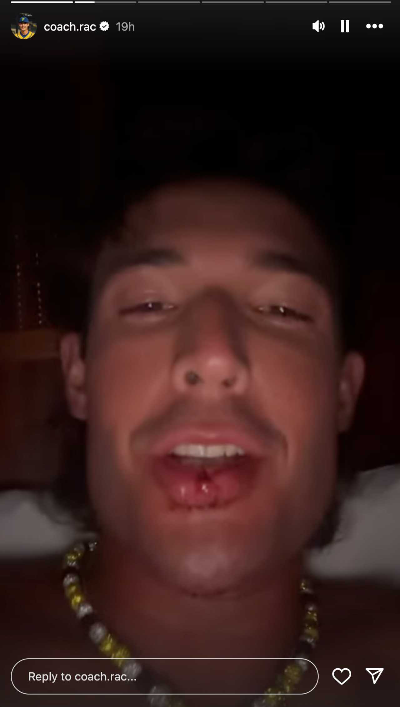 Robert Anthony Cruz Face Plants During Flip