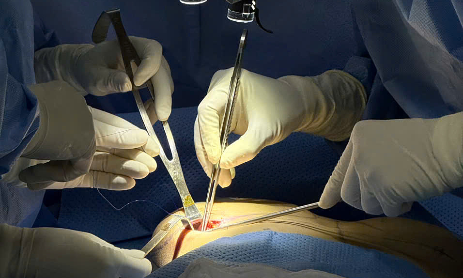 What is symmastia after breast augmentation?