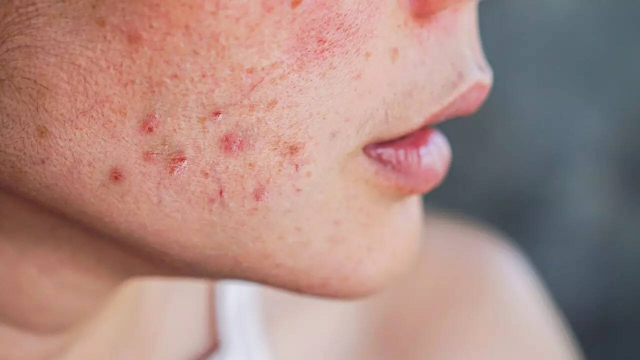How to know if your acne is actually a fungal infection: What is fungal ...