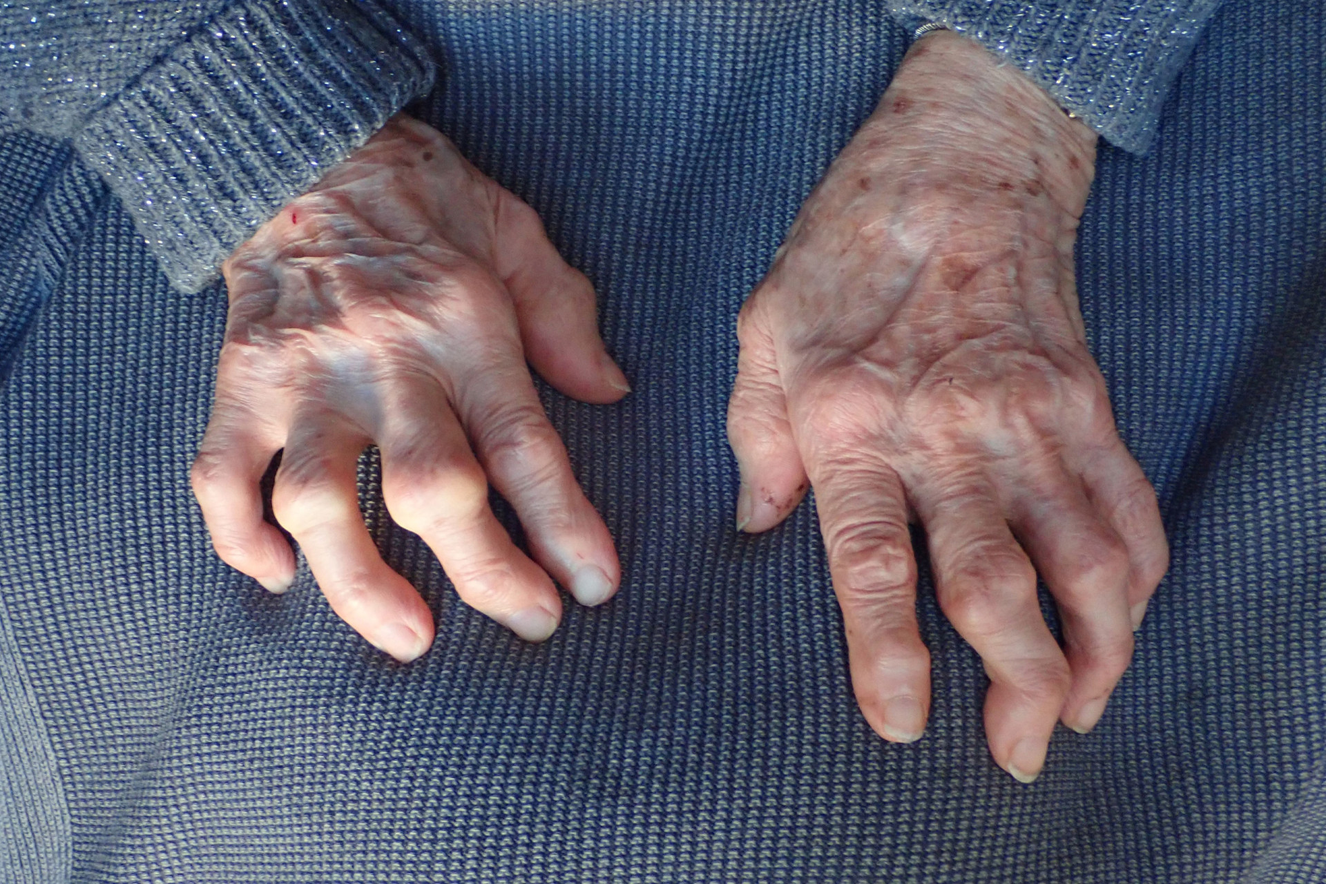 Arthritis and arthrosis: understanding the differences and treatments
