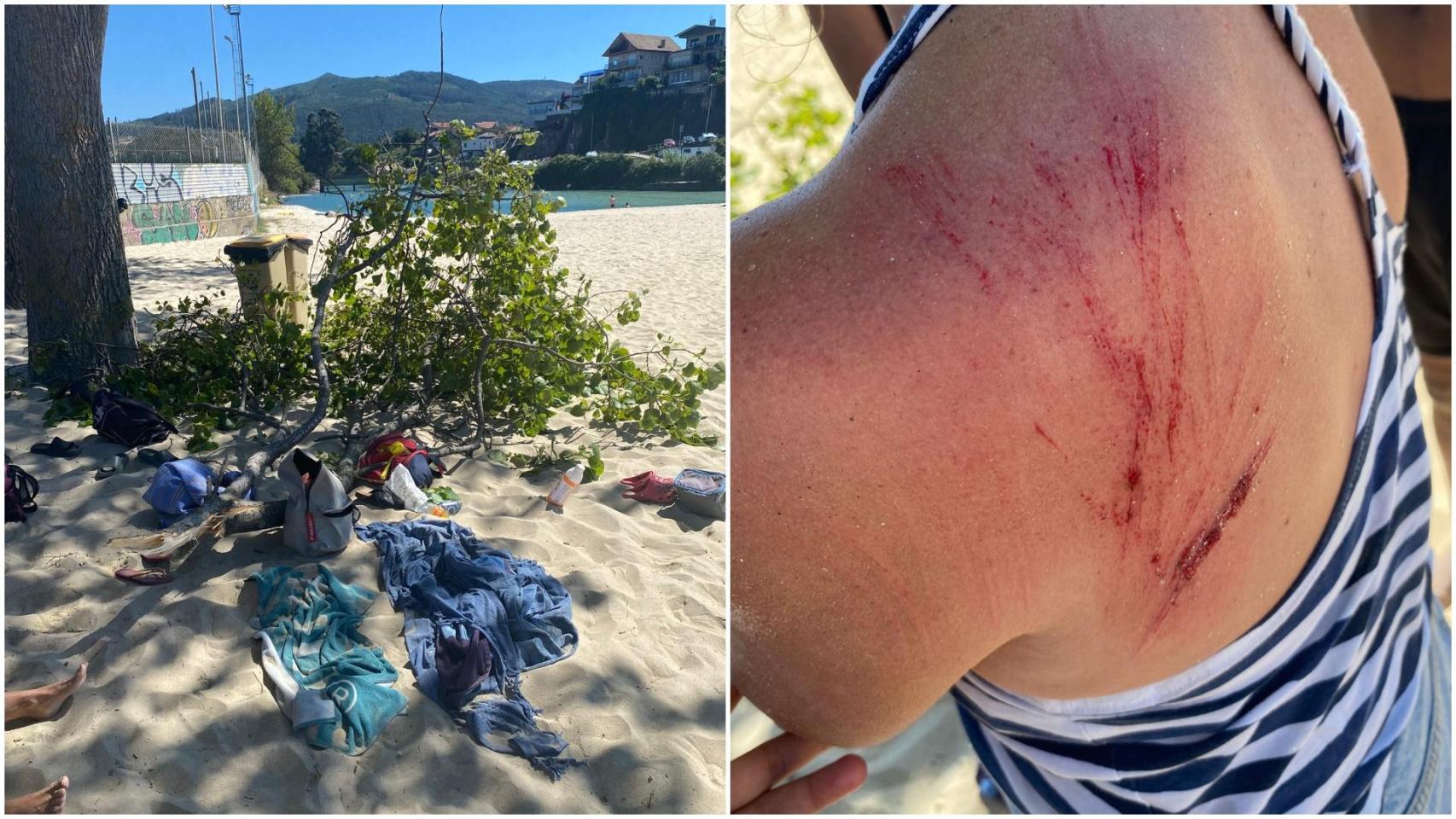 Sufre tres fracturas y múltiples contusiones tras caerle una rama de ...