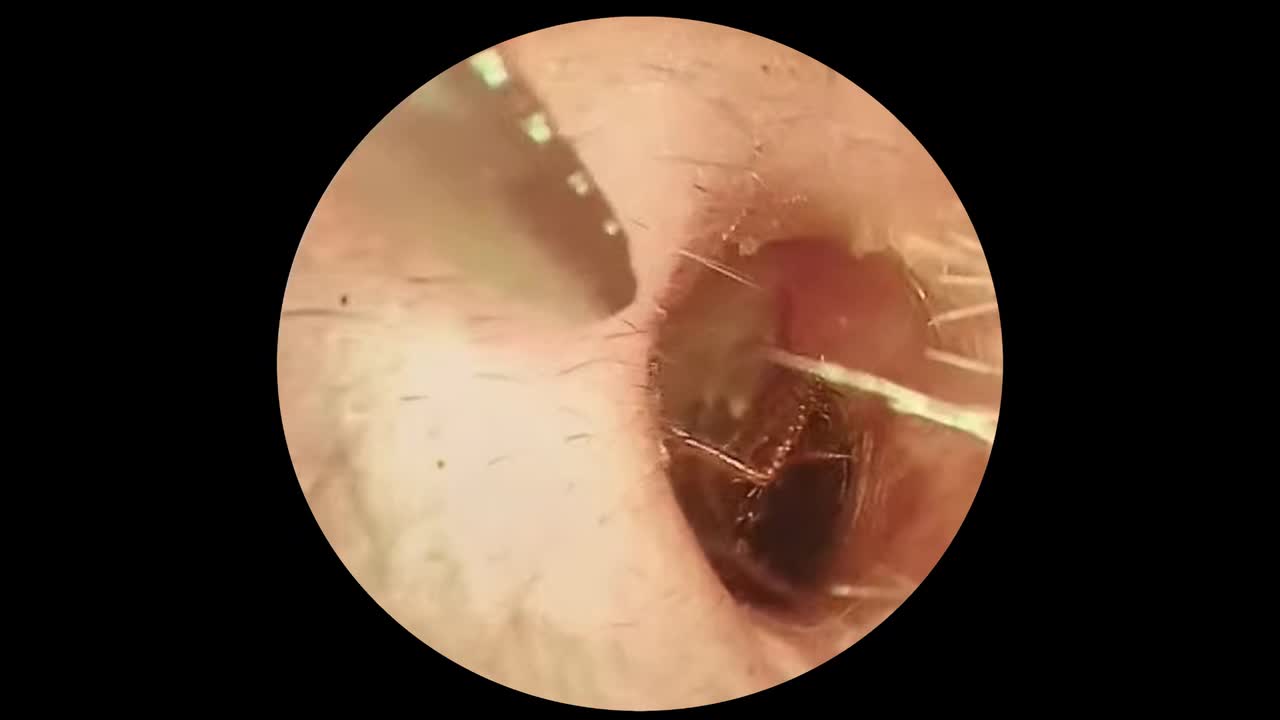 Doctor pulls LIVE cockroach from patient's ear in skin-crawling footage