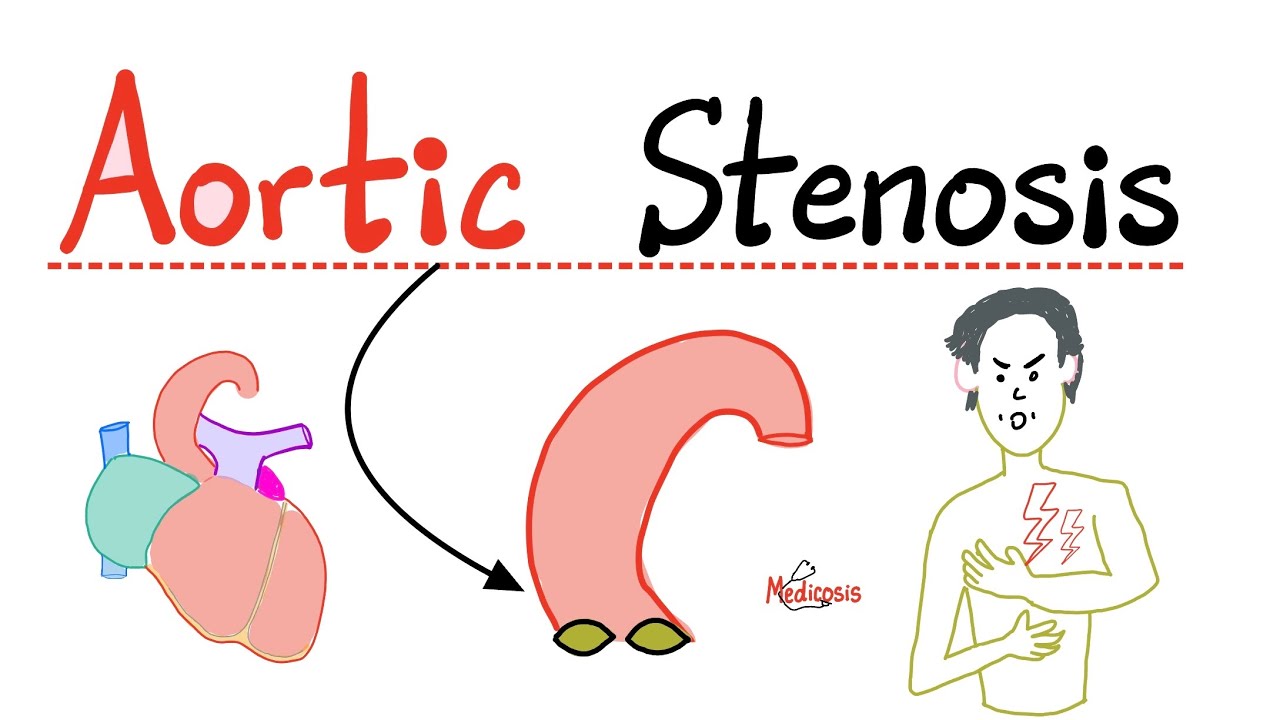 Aortic Stenosis (AS) - Valvular Heart Disease (VHD) - Causes, Symptoms ...