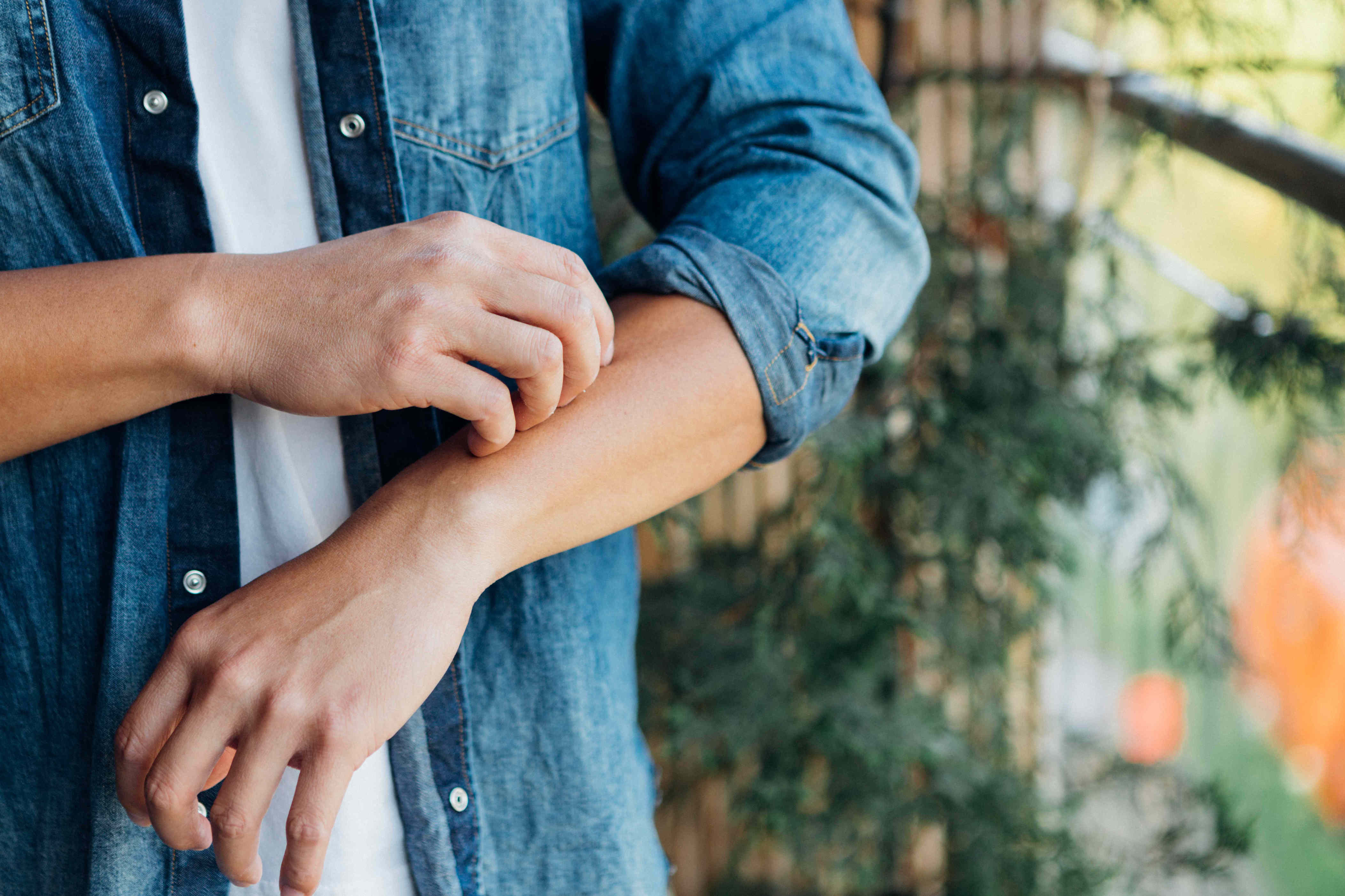 How to know if your mosquito bite is skeeter syndrome