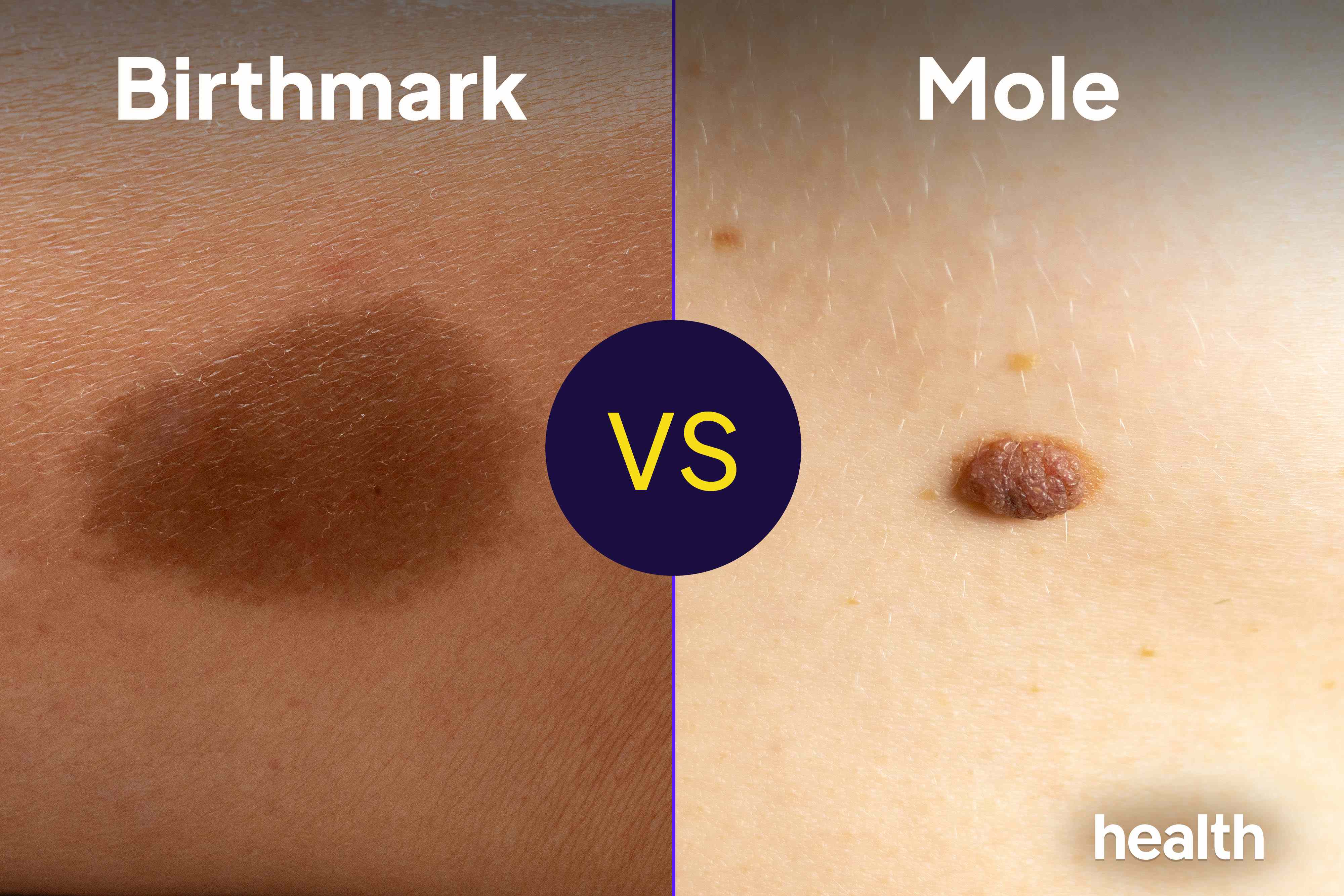 Is It a Mole or a Birthmark? Here’s Why You Should Know the Difference